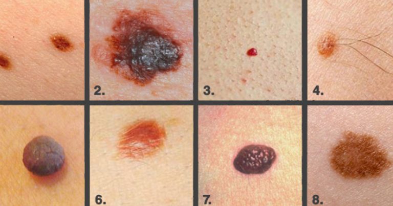 Here Is The Brilliant Guide To Identify And Prevent Skin Cancer | Born ...